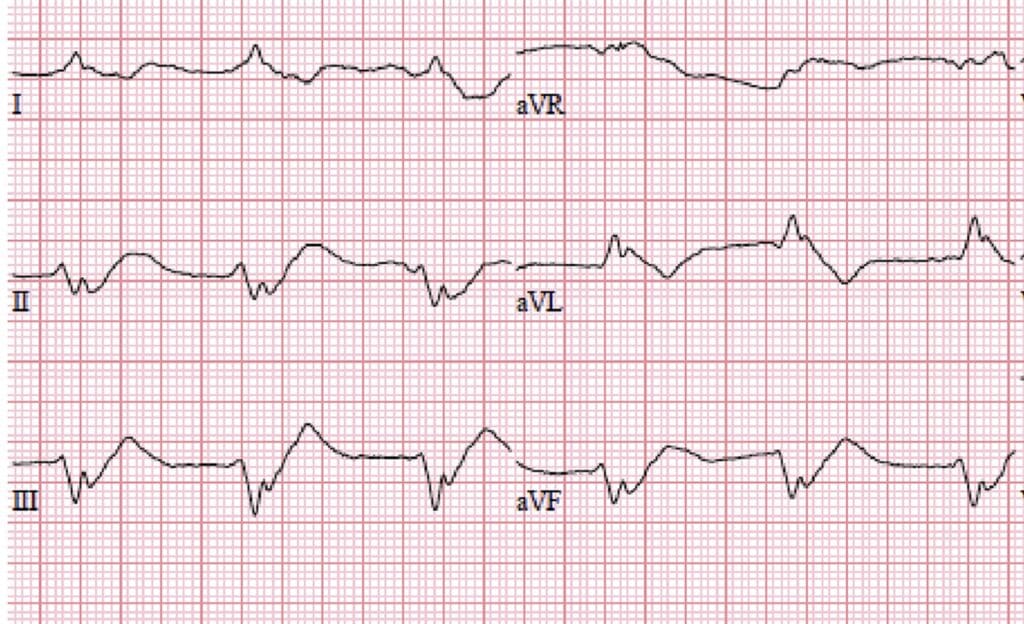 Hyperkalemia Associated with General Anesthesia in Dogs and Cats ...